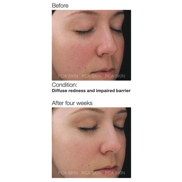PCA Skin Dual Action Redness Relief Serum – Anti-Aging Vancouver