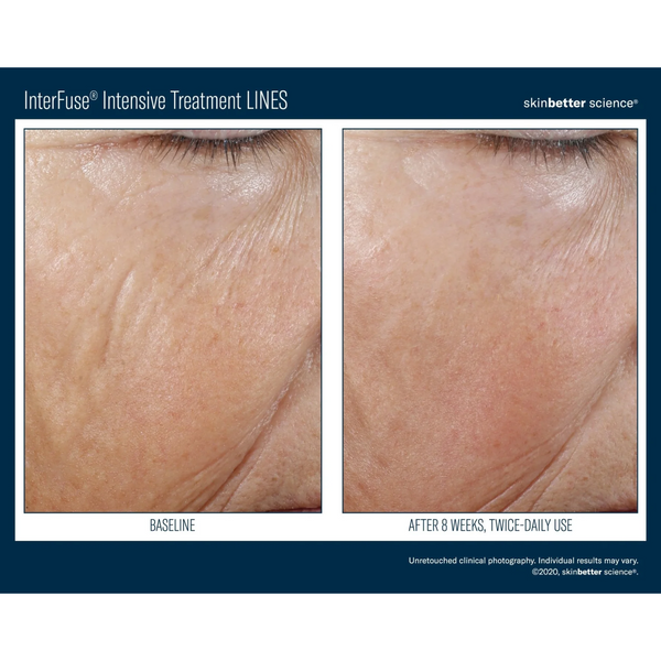 SkinBetter InterFuse® Intensive Lines – Anti-Aging Vancouver